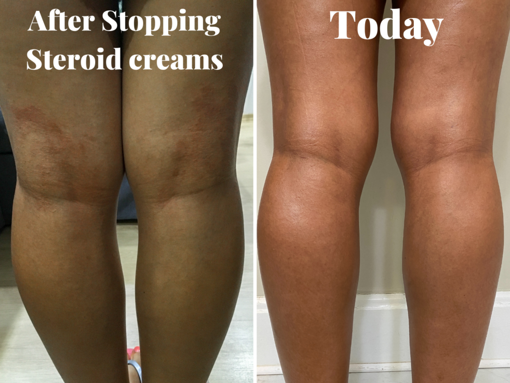 How To Get Rid Of Eczema | 5 Steps to Repair The Skin Barrier - Life in ...